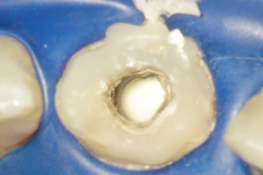 MTA placement with the Produits Dentaires MAP System