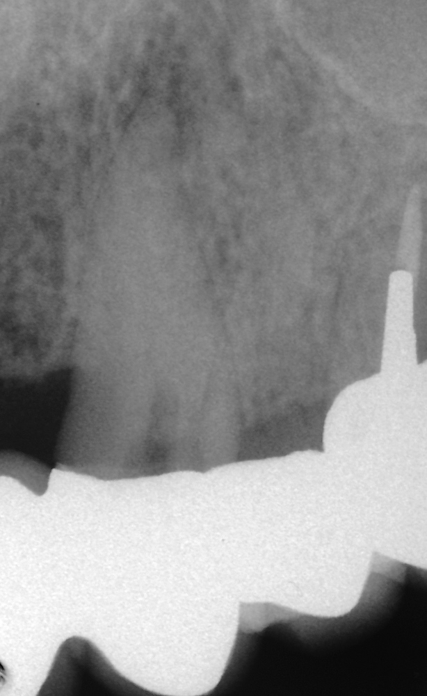 MTA placement with the Produits Dentaires MAP System