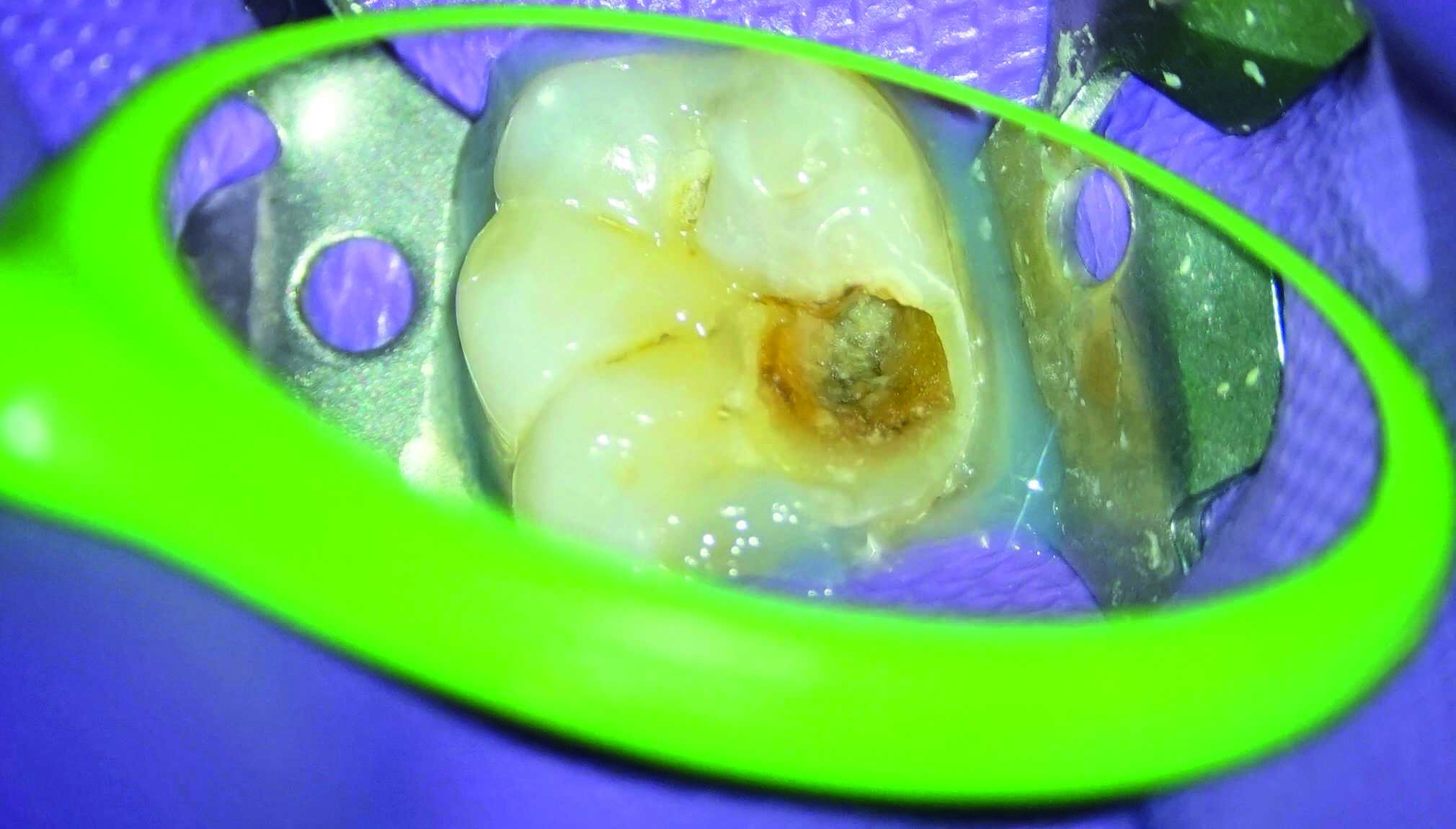 Direct pulp capping as a conservative procedure to maintain pulp vitality