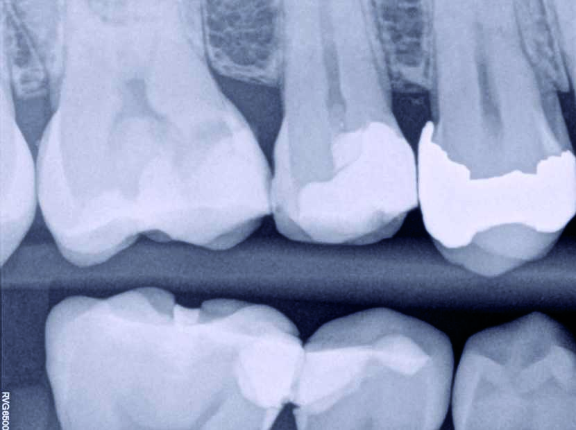 Direct pulp capping as a conservative procedure to maintain pulp vitality