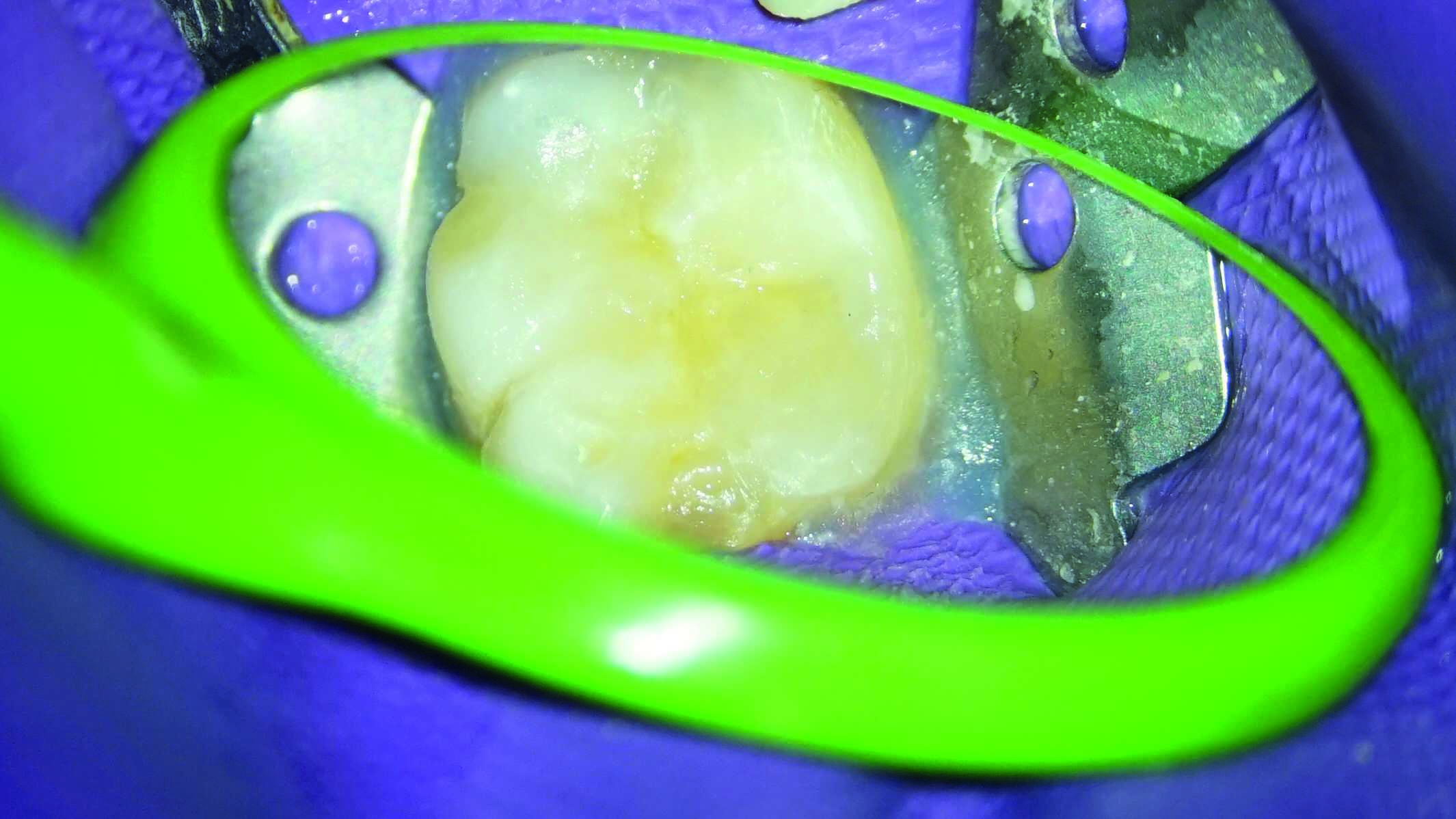 Direct pulp capping as a conservative procedure to maintain pulp vitality